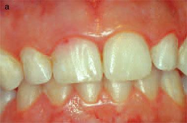 Invasive Cervical Resorption – Dentdiary