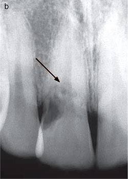 Invasive Cervical Resorption – Dentdiary