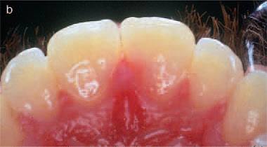 Invasive Cervical Resorption – Dentdiary