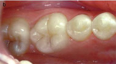 Invasive Cervical Resorption – Dentdiary
