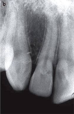 Invasive Cervical Resorption – Dentdiary