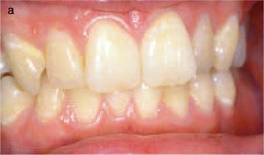 Invasive Cervical Resorption – Dentdiary